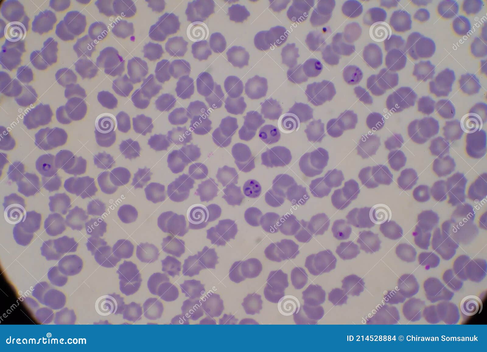 Blood Parasite Infected Red Blood Cells Malaria Stock Photo - Image of ...