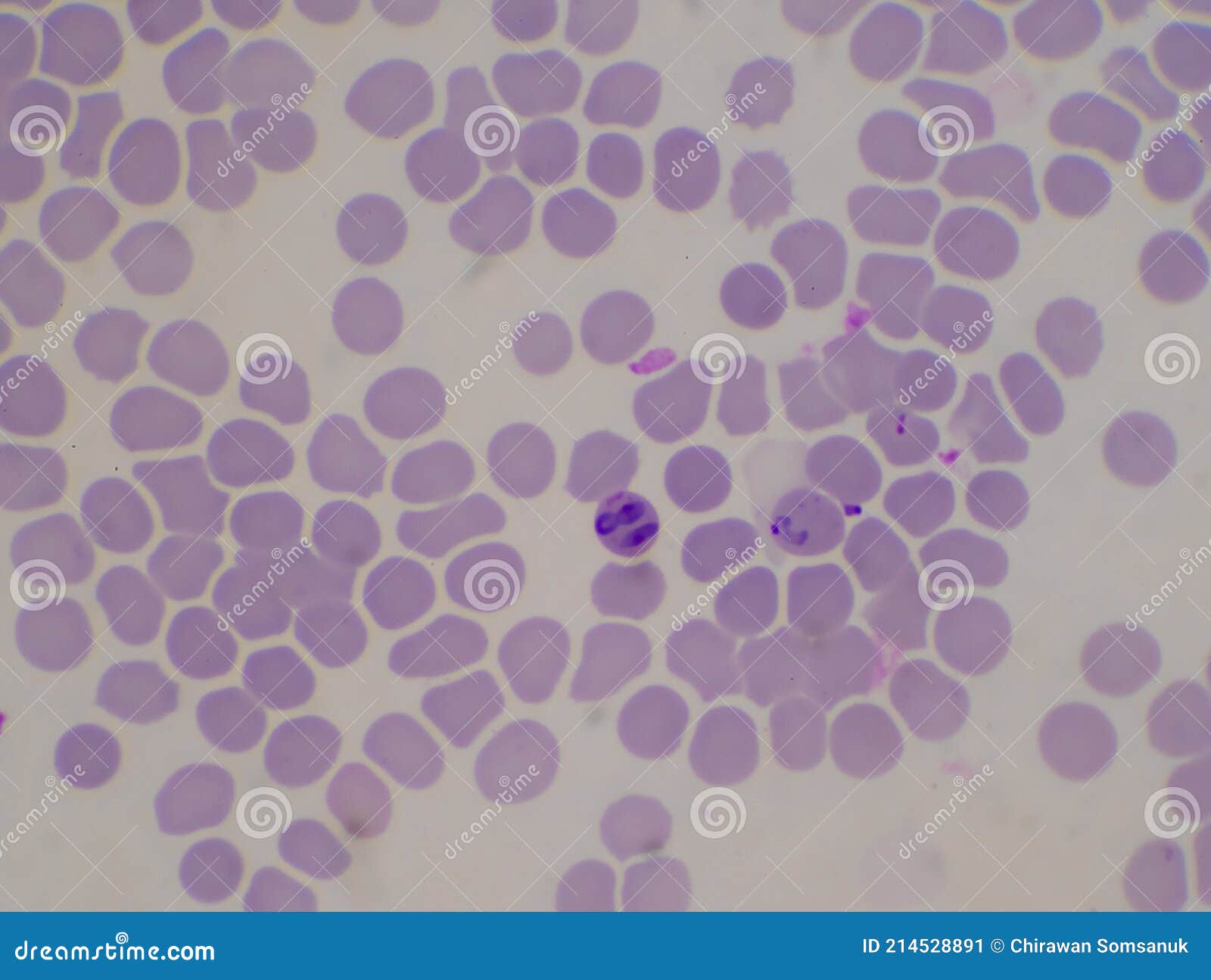 Blood Parasite Ring Form Malaria Infected Red Blood Cells Stock Photo ...