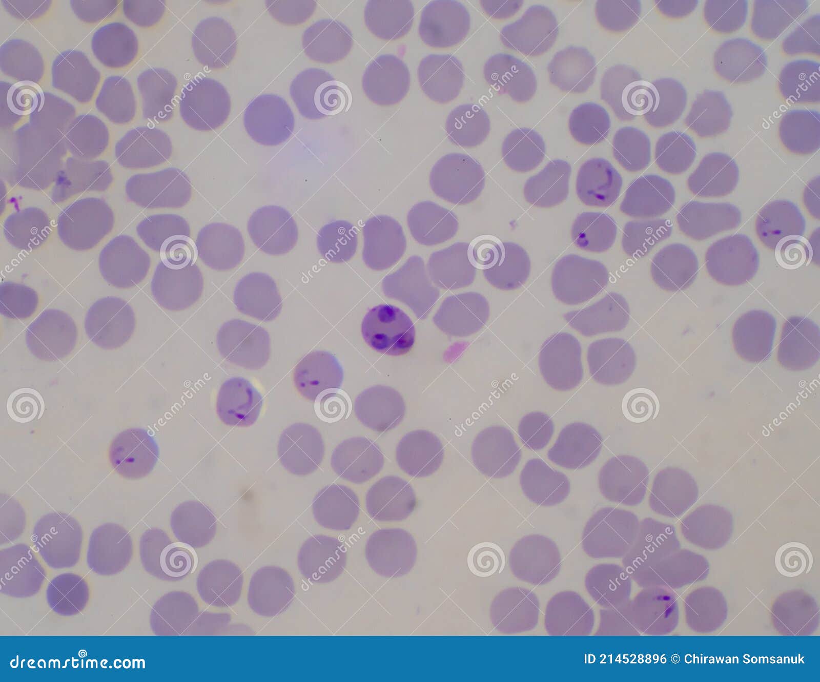 Blood Parasite Infected Red Blood Cells Malaria Stock Photo - Image of ...
