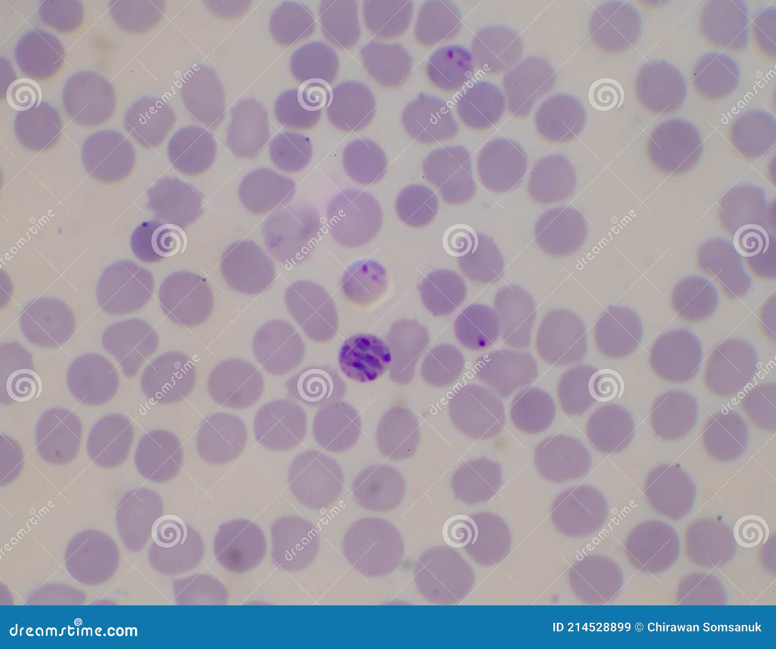 Blood Parasite Infected Red Blood Cells Malaria Stock Image - Image of ...