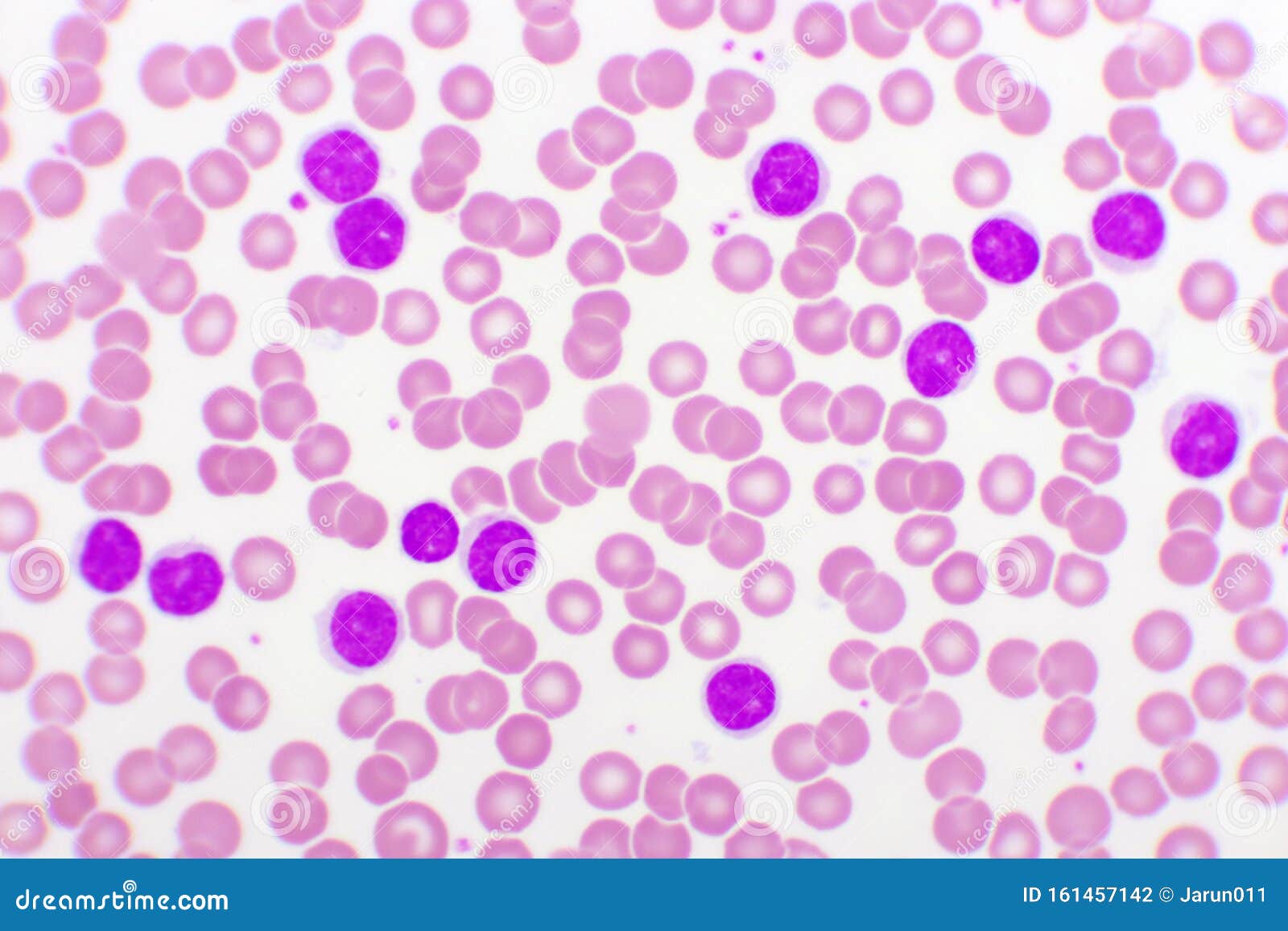 Blood Picture of Chronic Lymphocytic Leukemia or CLL Stock Photo ...