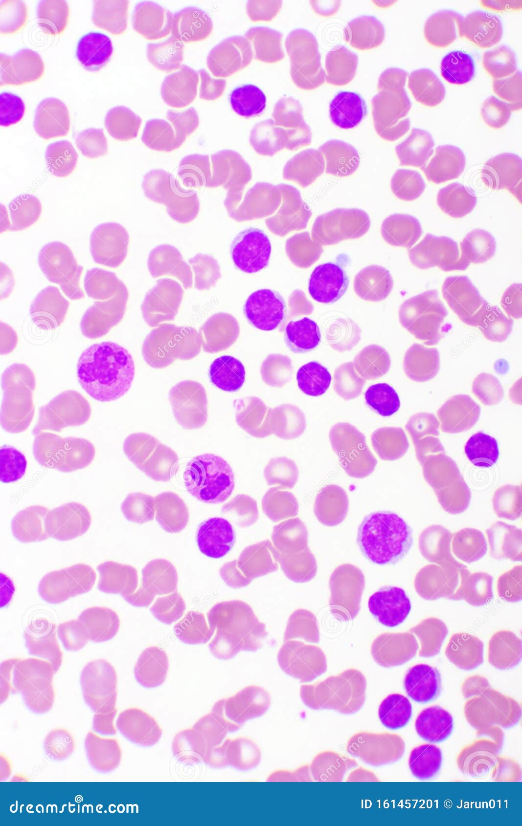 Blood Picture of Chronic Lymphocytic Leukemia or CLL Stock Image ...