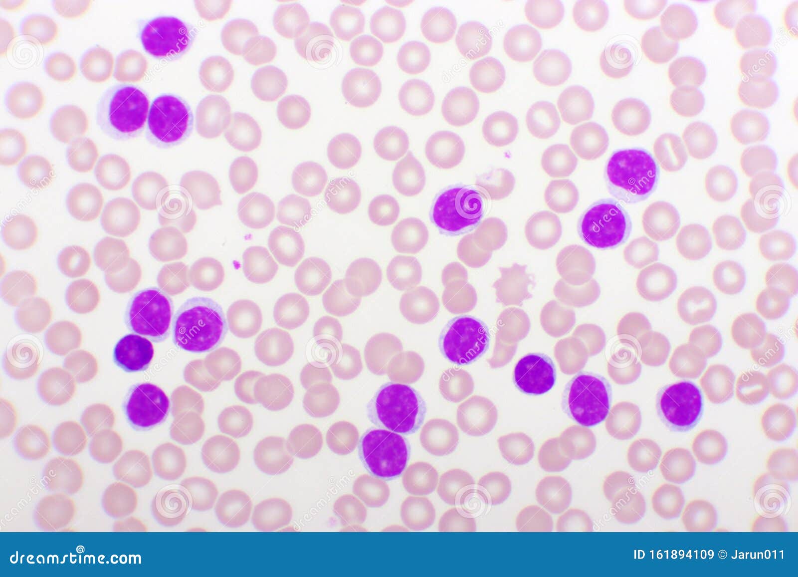 Blood Picture of Chronic Lymphocytic Leukemia or CLL Stock Image ...