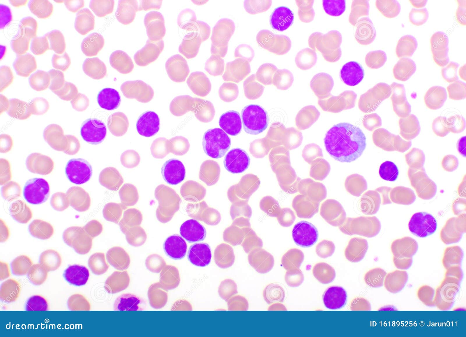 Blood Picture of Chronic Lymphocytic Leukemia or CLL Stock Photo ...