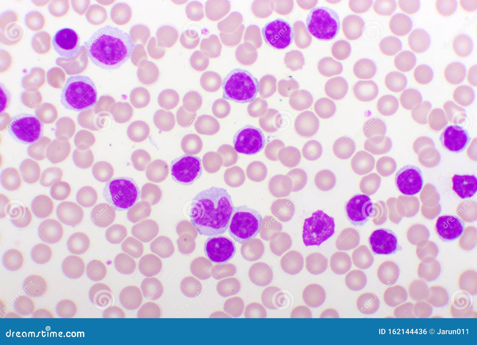 Blood Picture of Chronic Lymphocytic Leukemia Stock Photo - Image of ...