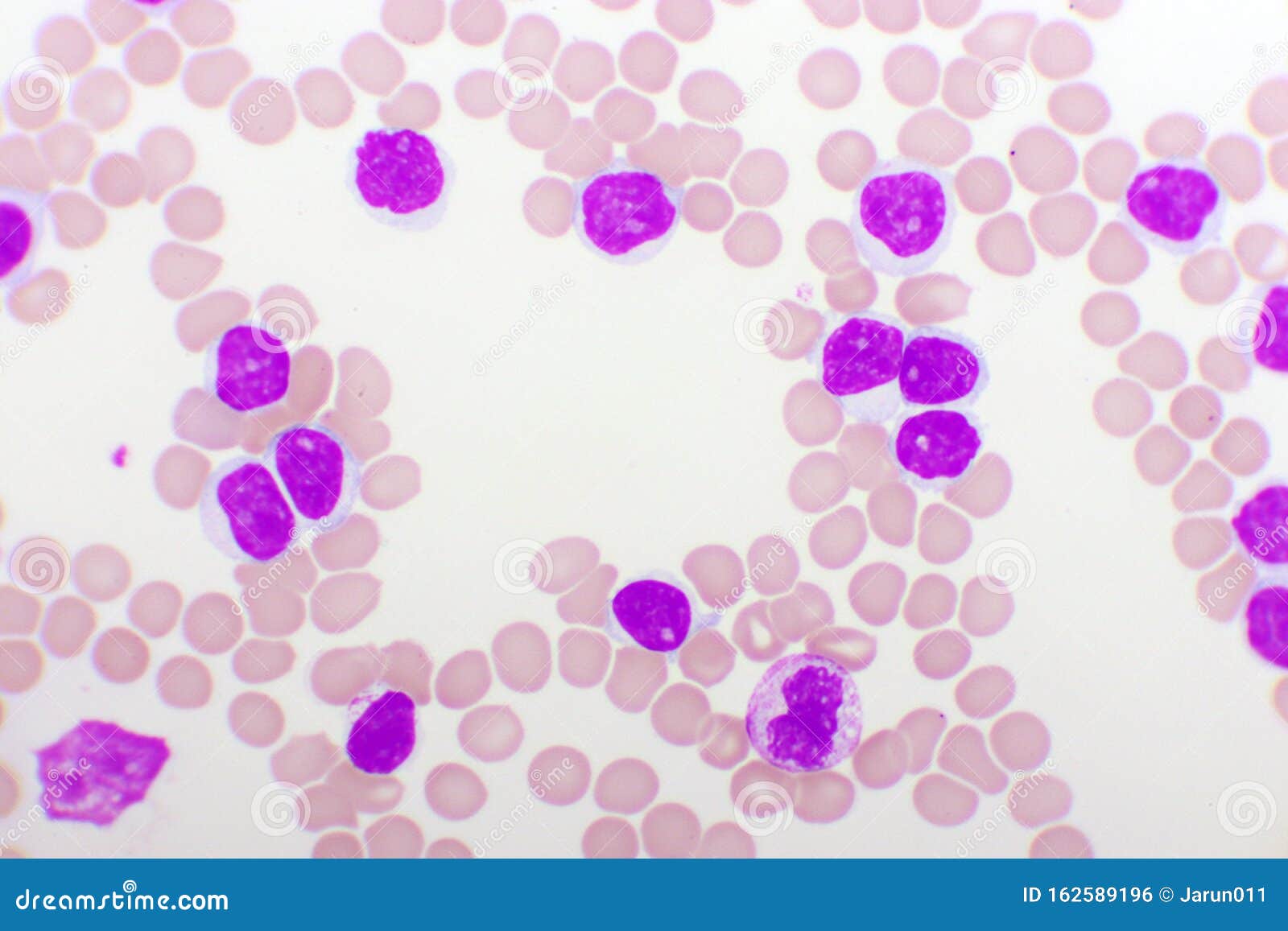 Blood Picture of Chronic Lymphocytic Leukemia or CLL Stock Photo ...