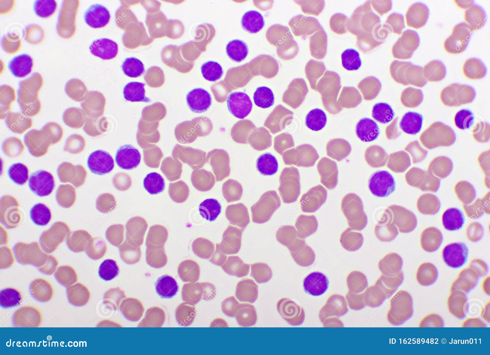 Blood Picture of Chronic Lymphocytic Leukemia or CLL Stock Photo ...