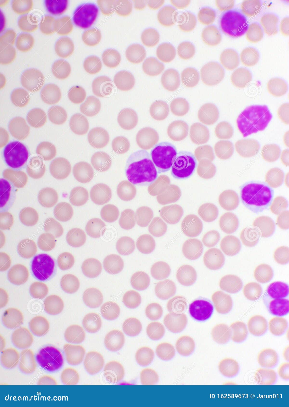 Blood Picture of Chronic Lymphocytic Leukemia or CLL Stock Image ...