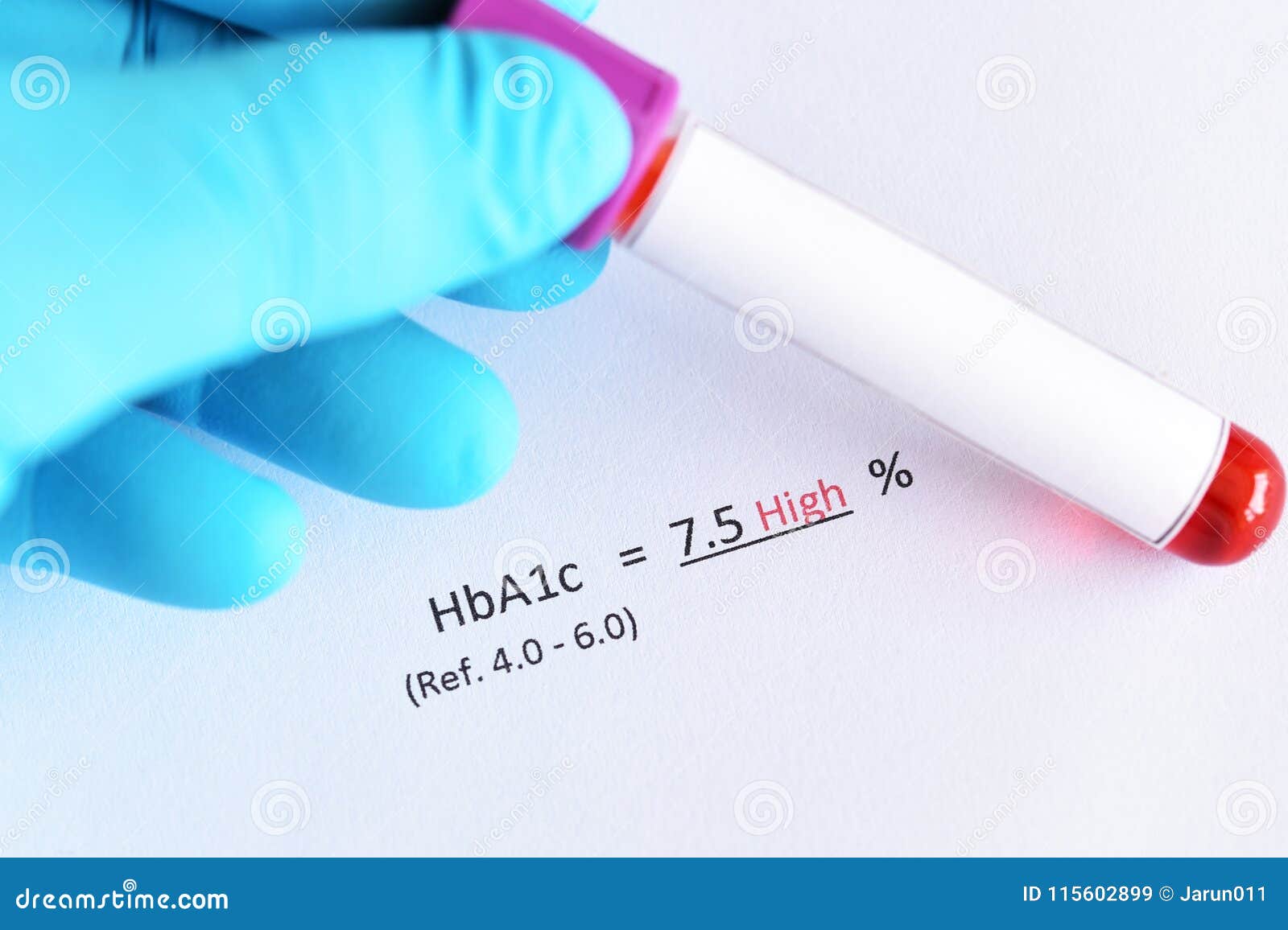 Abnormal High HbA1c Test Result Stock Image - Image of diabetes, test ...