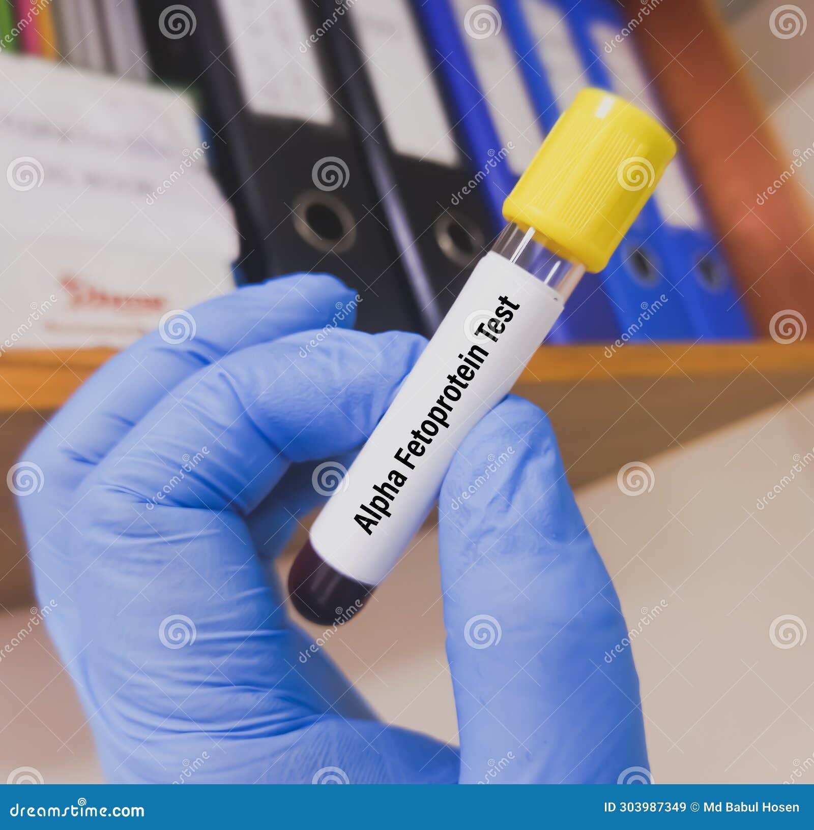 Blood Sample for Alpha-fetoprotein (AFP) Total and L3 Level Testing ...