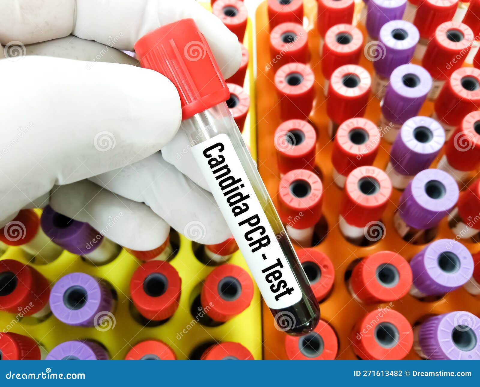 Blood Sample for Candida PCR Test Stock Photo - Image of gynecology ...