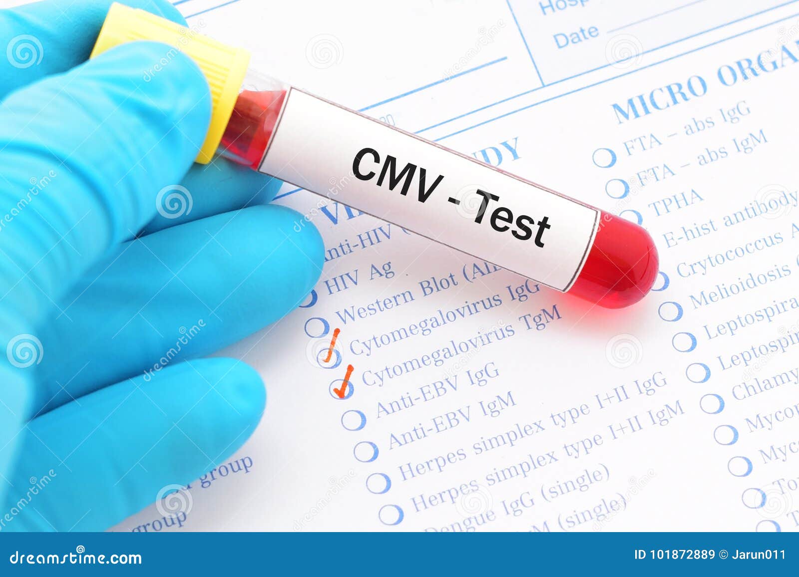 CMV test stock image. Image of hematology, experiment - 101872889