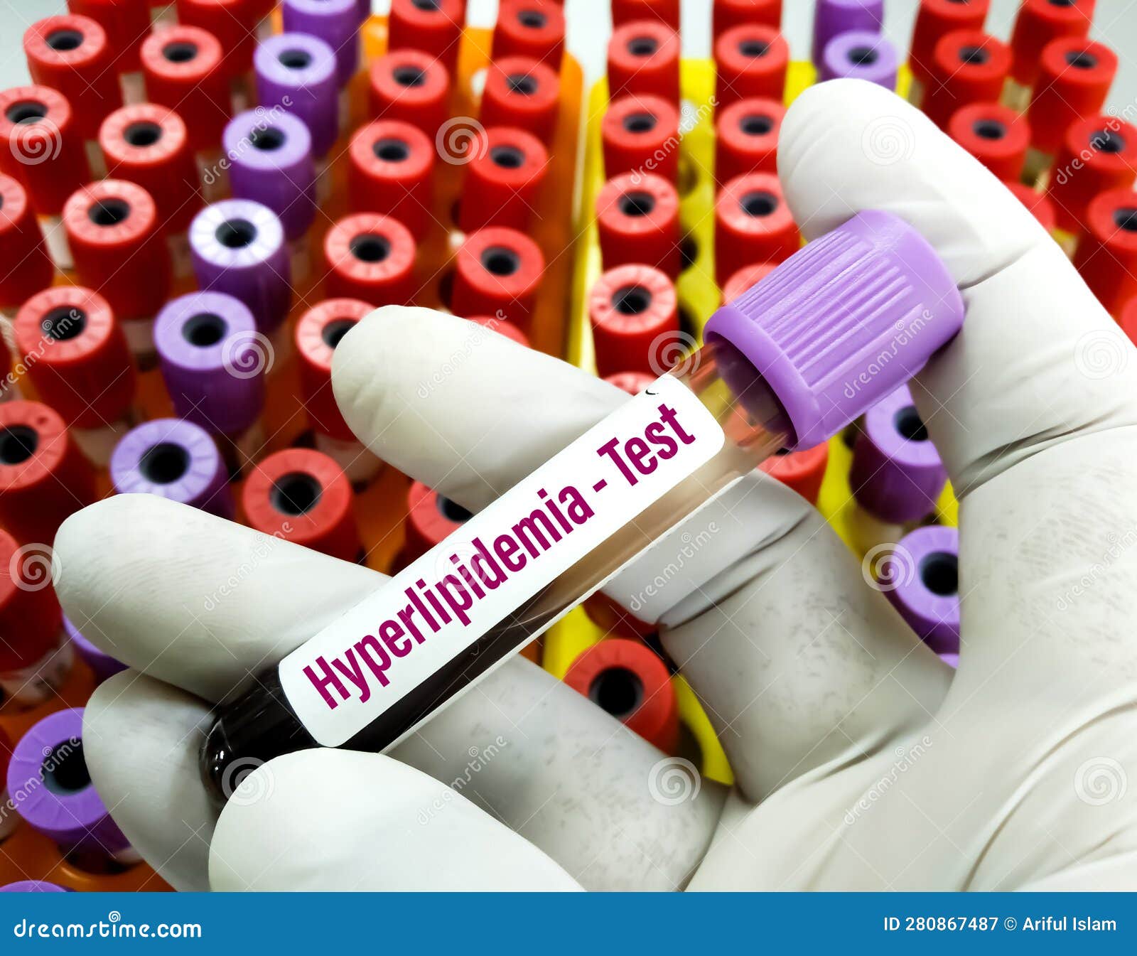 Blood Sample for Hyperlipidemia Test. Stock Image - Image of ferritin ...