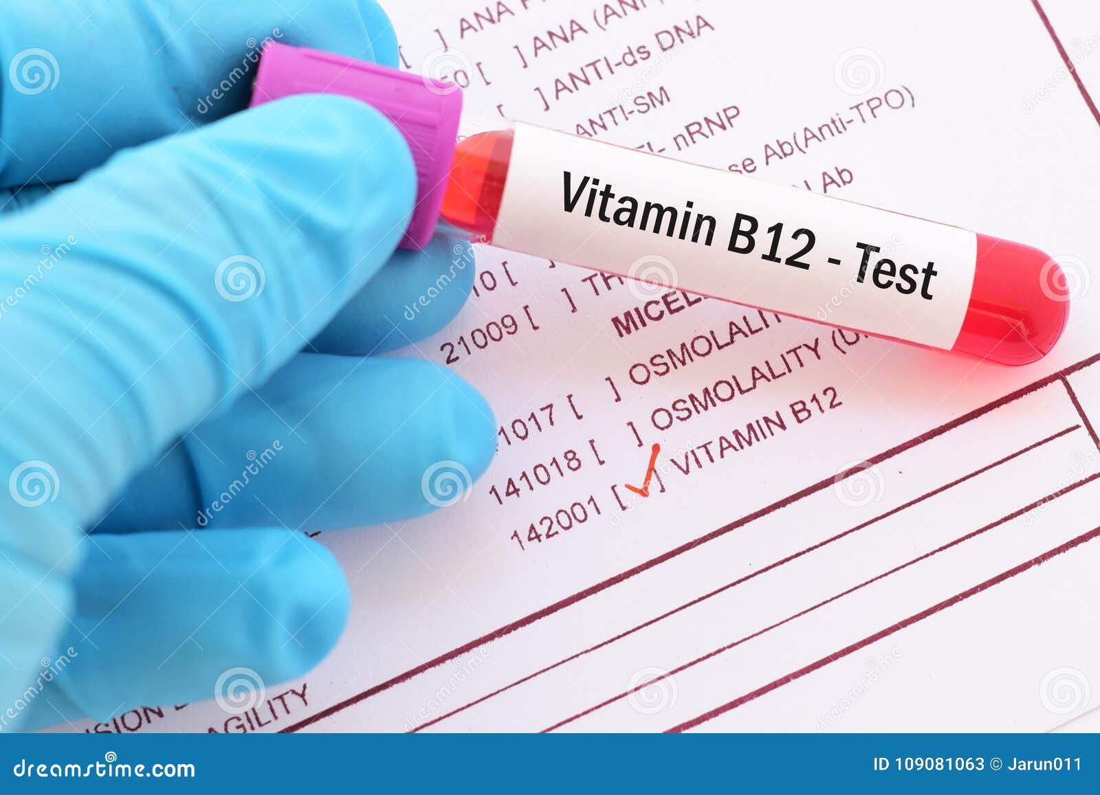 Blood Sample for HBV Viral Load Test Stock Image - Image of reaction ...