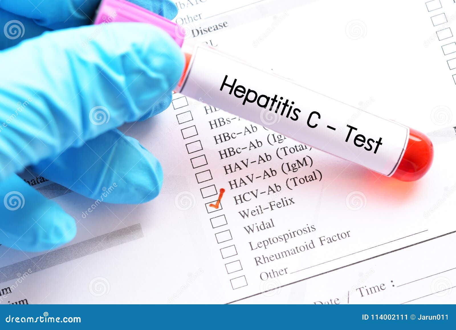 Hepatitis C virus test stock image. Image of disease - 114002111