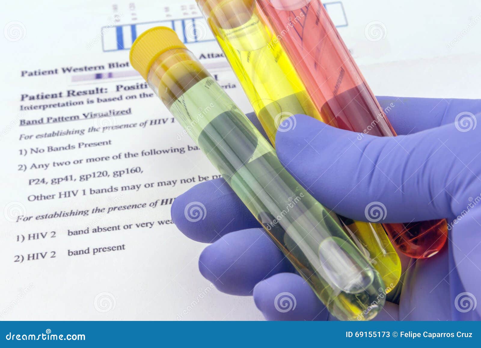Blood Sample and Lab Request for Anti-HIV Testing Stock Image - Image ...