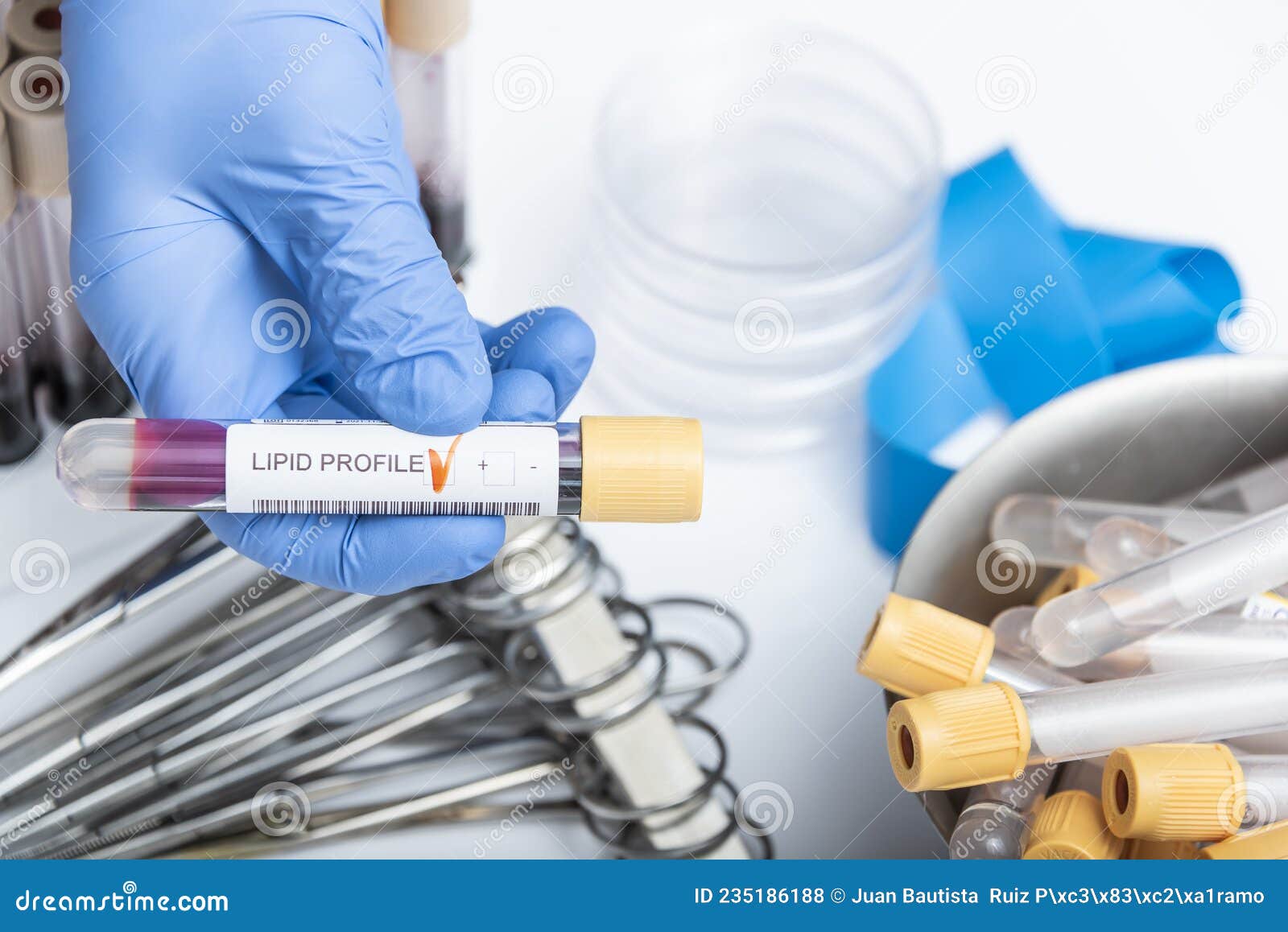 Blood Sample for Lipid Profile Testing. Medical Technology Stock Photo ...