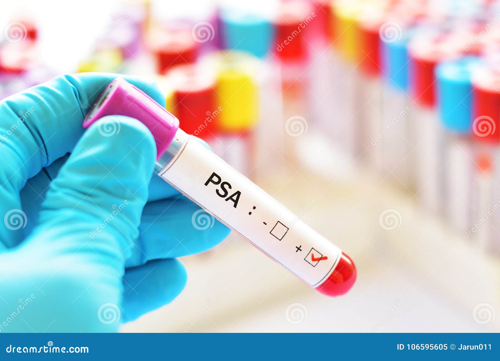 PSA positive blood sample stock image. Image of marker - 106595605