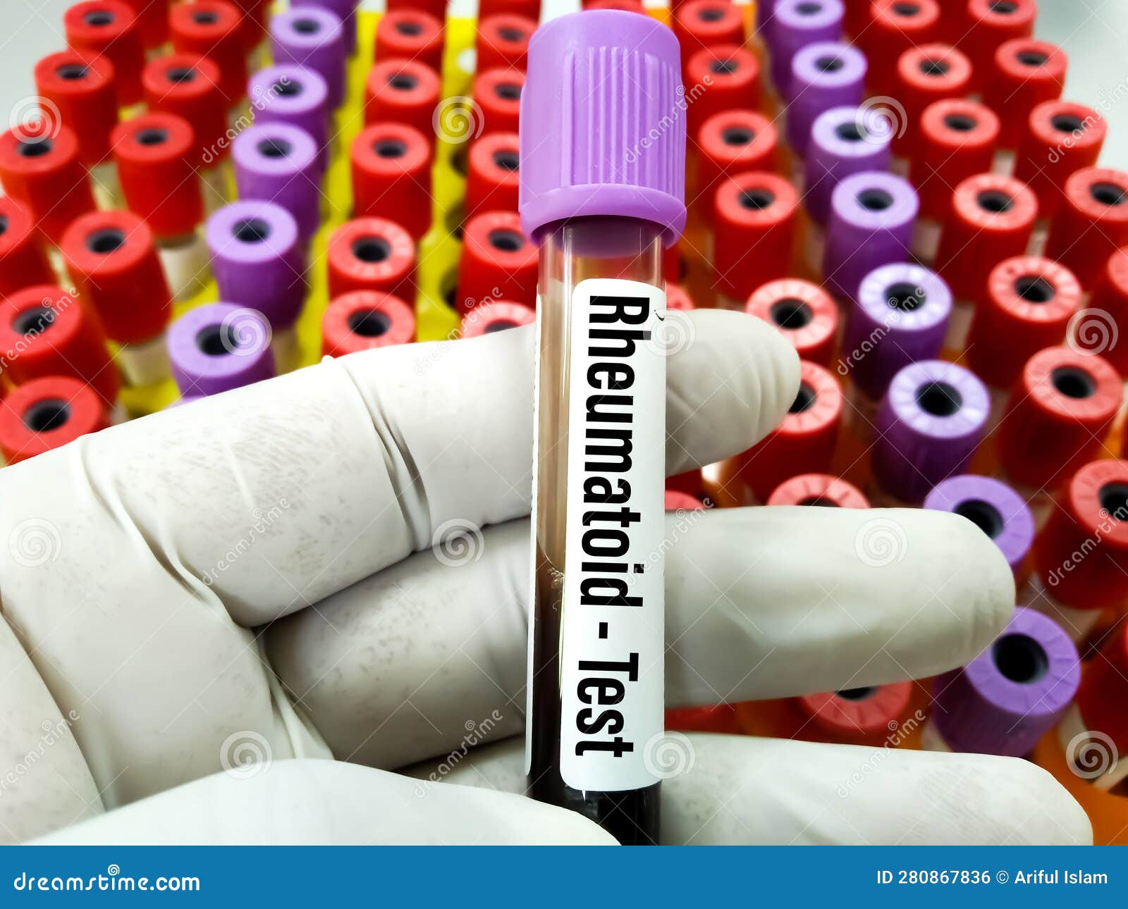 Blood Sample for Rheumatoid Test. Stock Photo - Image of blood ...