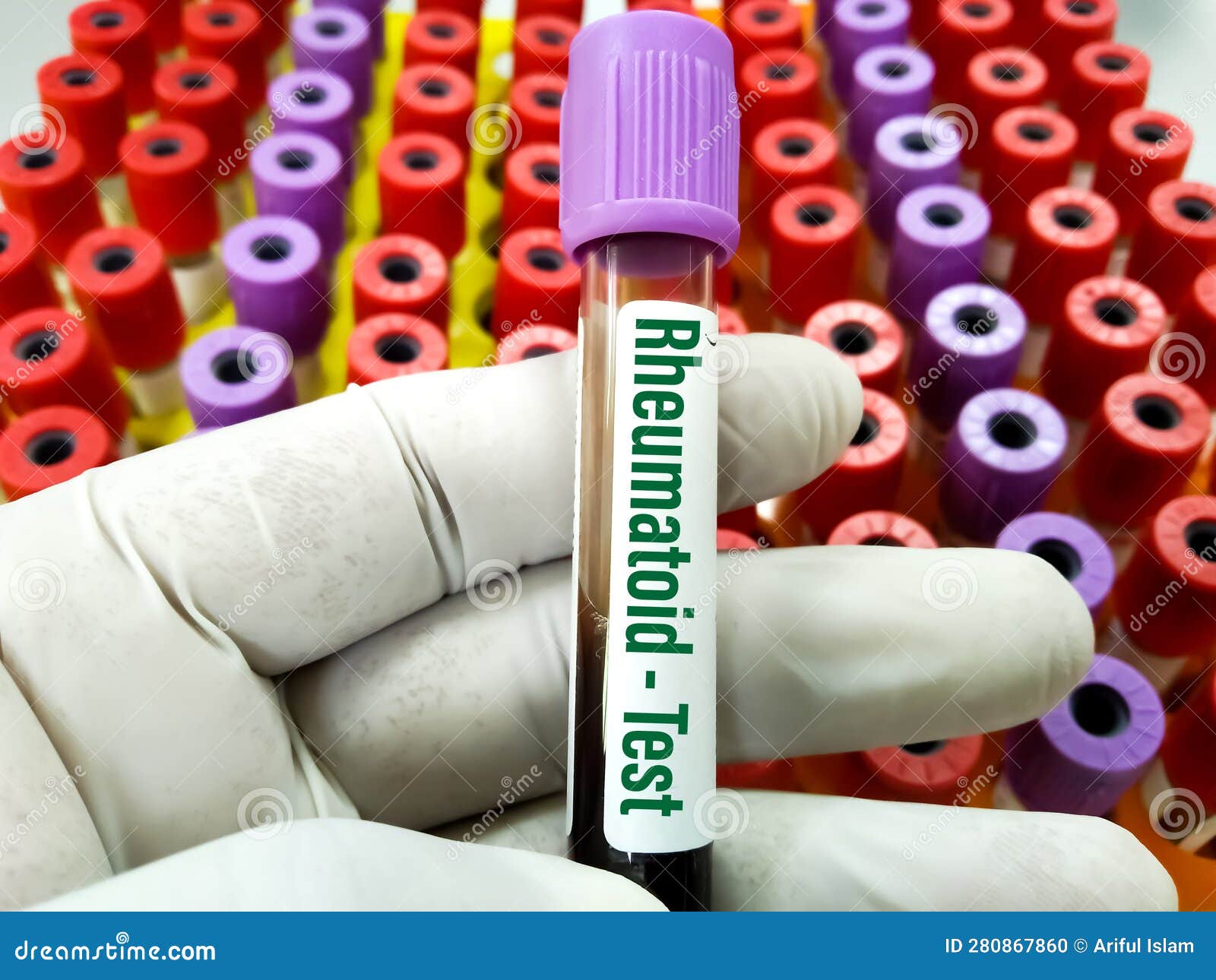 Blood Sample for Rheumatoid Test. Stock Photo - Image of drug, dessert ...
