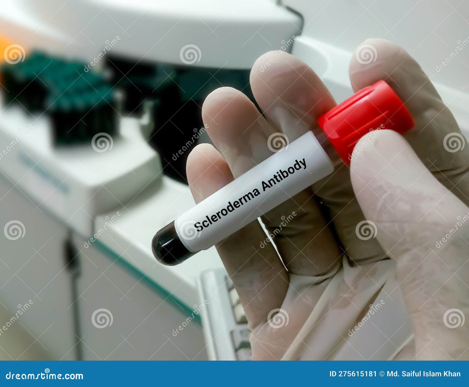 Blood Sample for Scleroderma. CREST Syndrome Stock Image - Image of ...