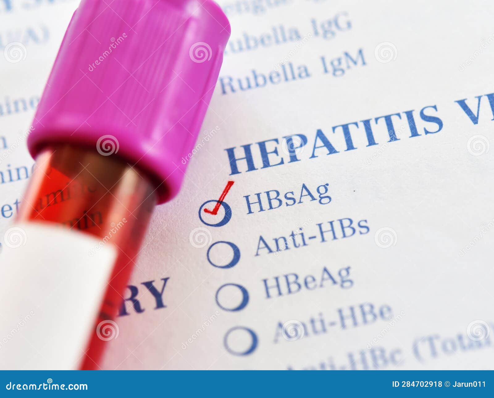 Blood Sample Tube for Hepatitis B Virus Test Stock Photo - Image of ...