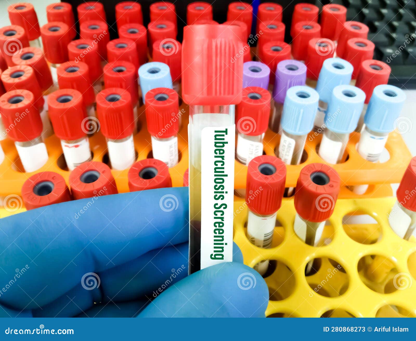 Blood Sample for Tuberculosis Screening Test. Stock Image - Image of ...