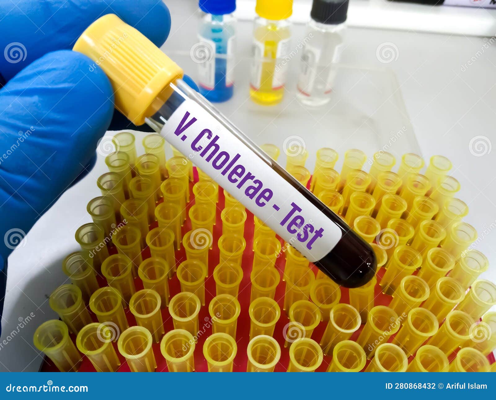 Blood Sample for Vibrio Cholerae Test Stock Photo - Image of fibroblast ...