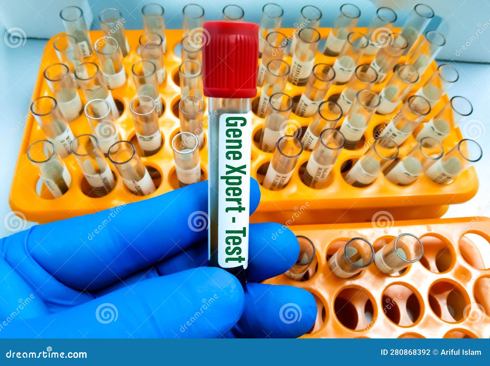 Blood Sample for Vibrio Cholerae Test Stock Photo - Image of serology ...