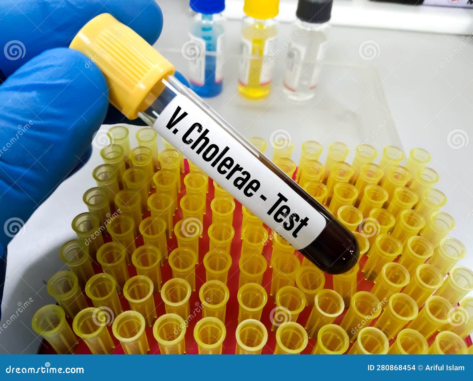 Blood Sample for Vibrio Cholerae Test Stock Photo - Image of fgf23 ...