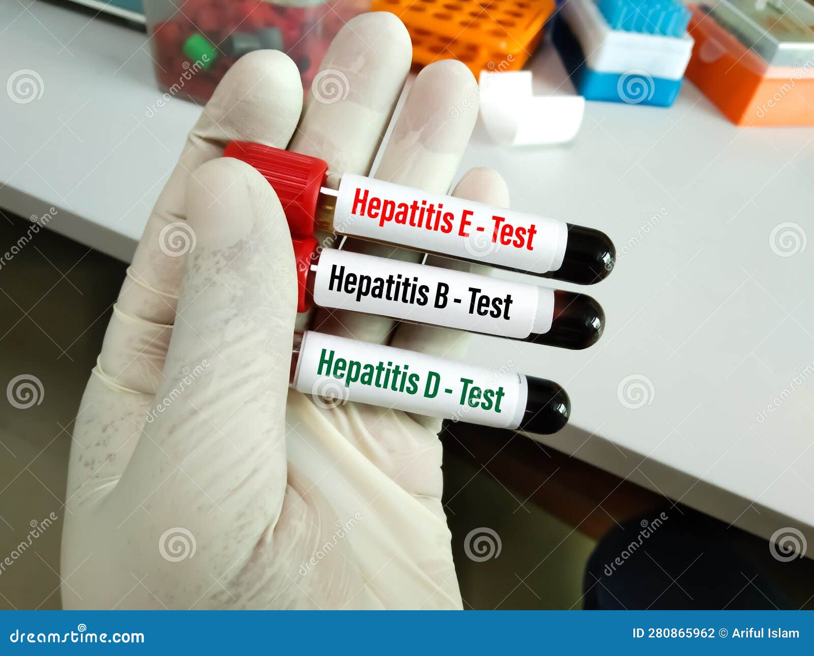 Blood Samples Tube with Sample for Hepatitis Virus Test. Stock Photo ...