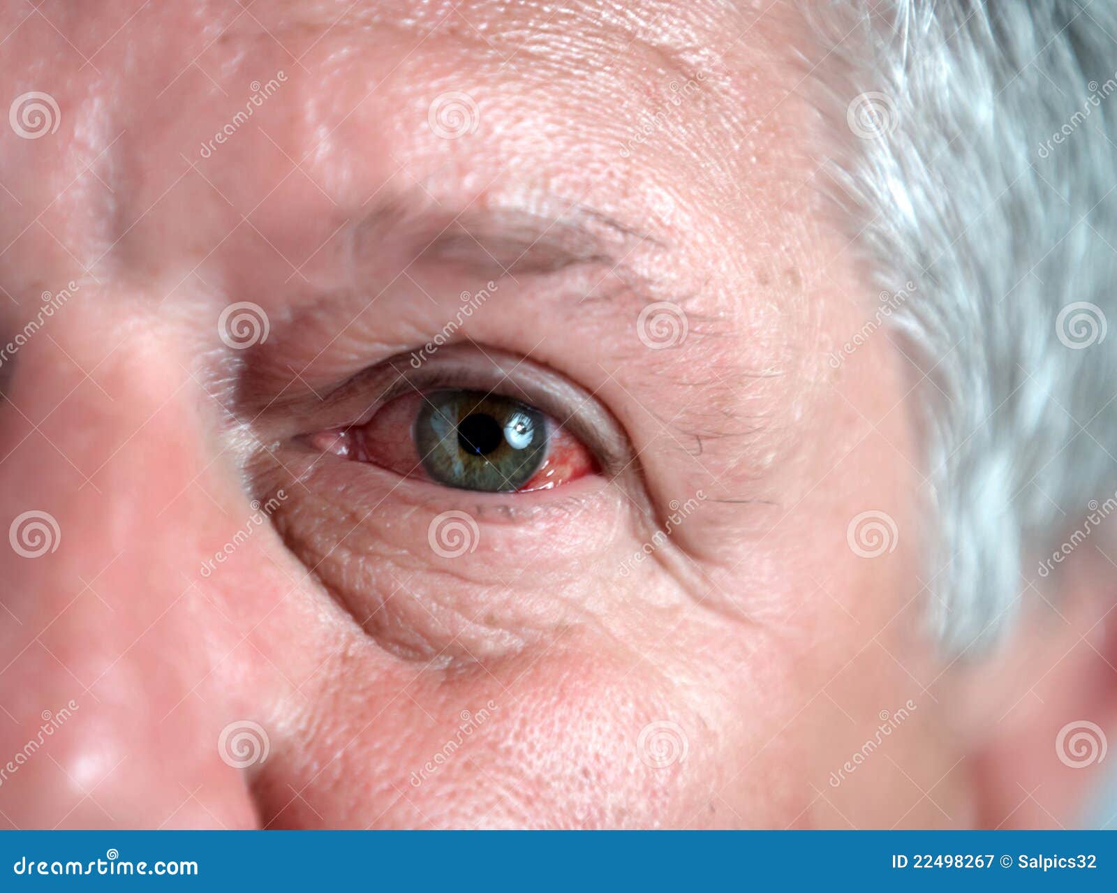 Blood shot eye stock image. Image of bleeding, conjunctivitis - 22498267