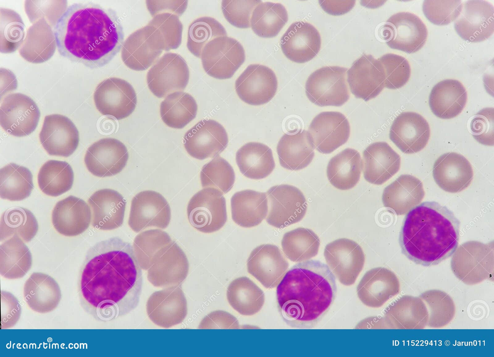 Blood Smear of Chronic Lymphocytic Leukemia Stock Image - Image of ...