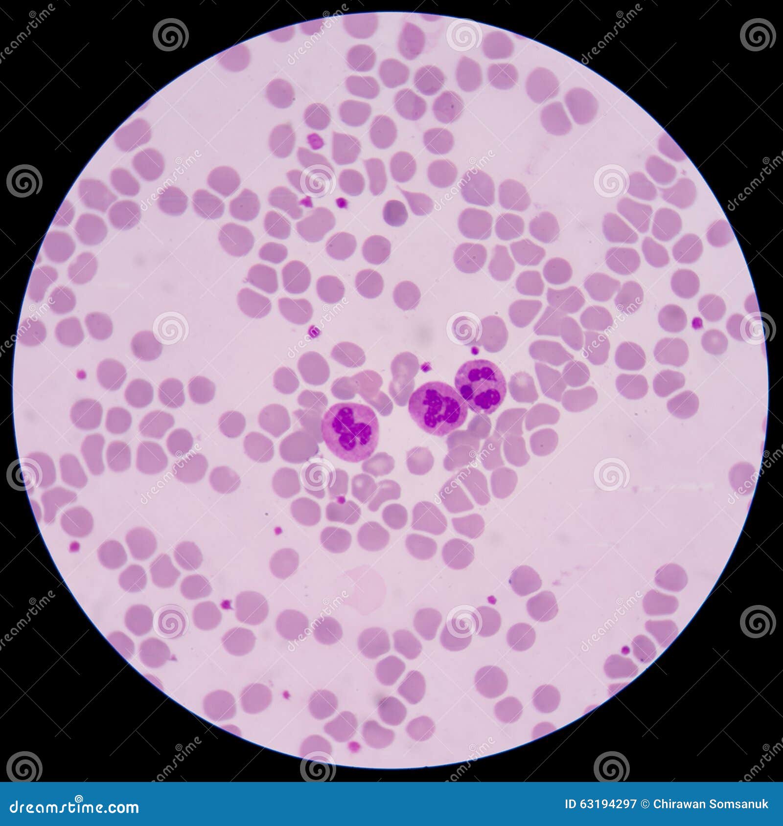 Blood smear form sepsis. stock image. Image of hand, infection - 63194297