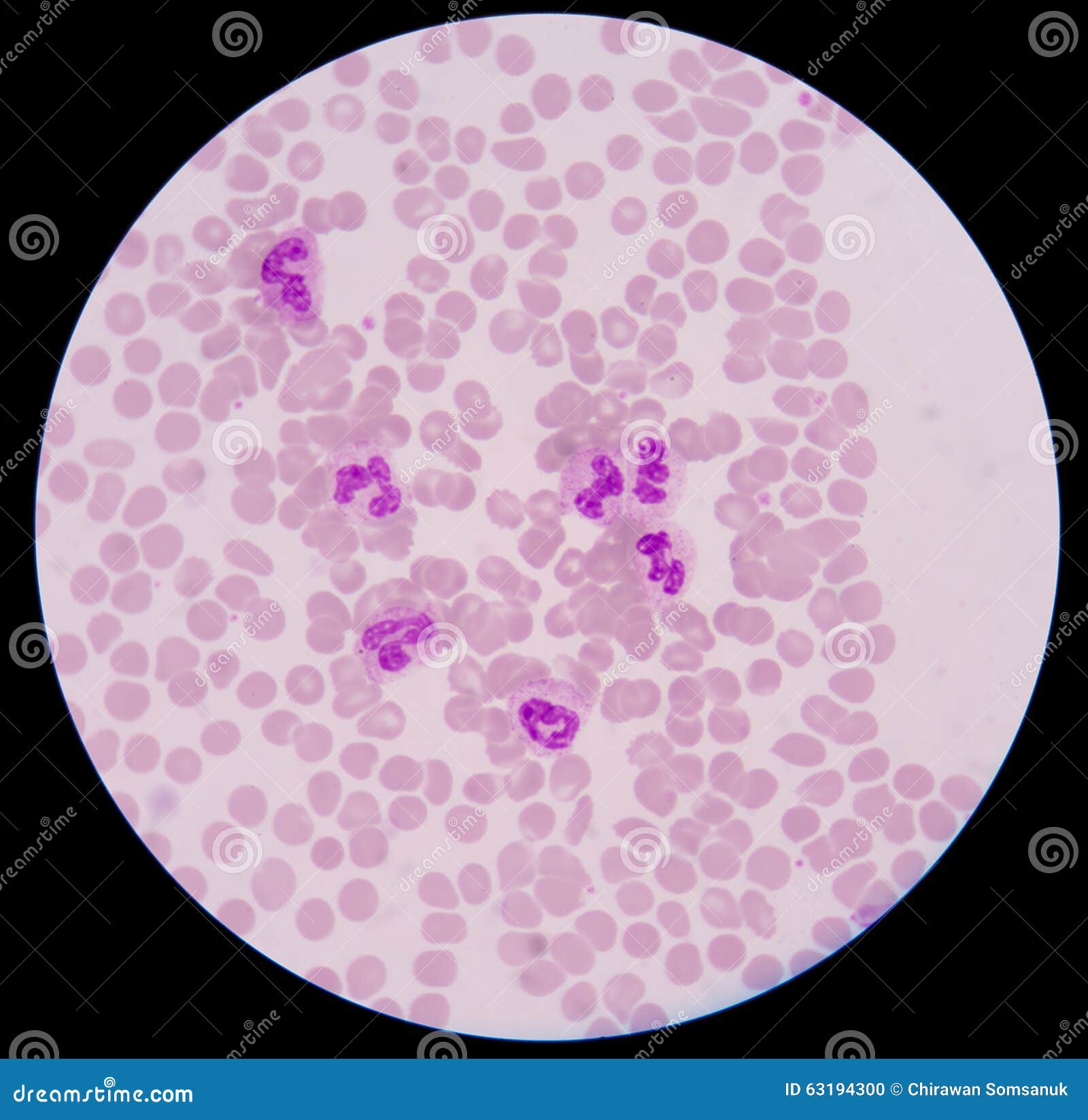 Blood smear form sepsis. stock photo. Image of blood - 63194300