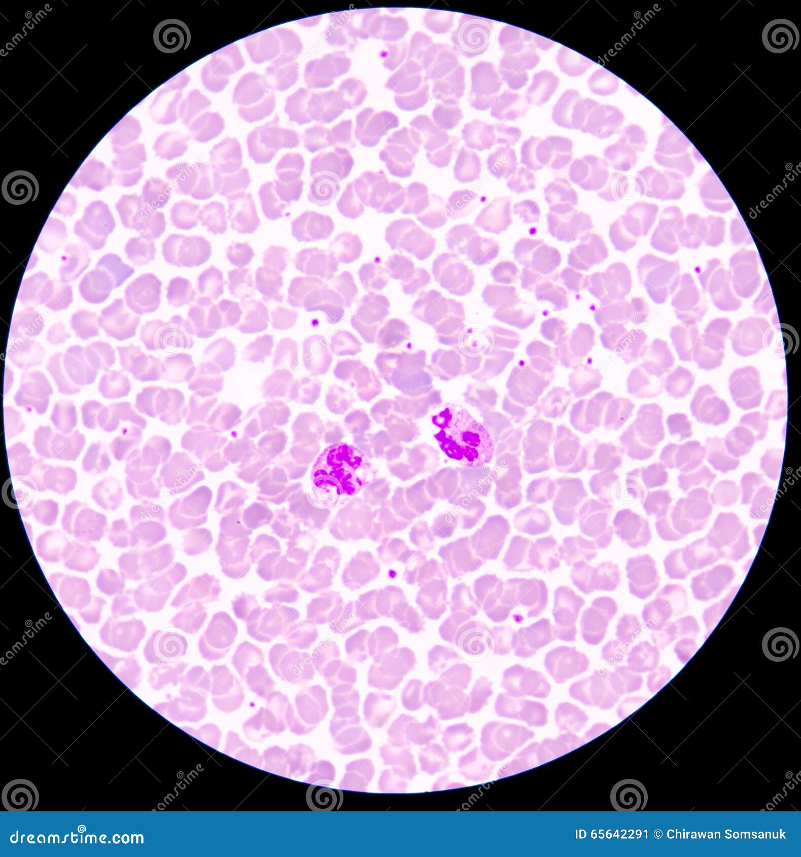 Blood Smear Form Sepsis. Royalty-Free Stock Photography | CartoonDealer ...