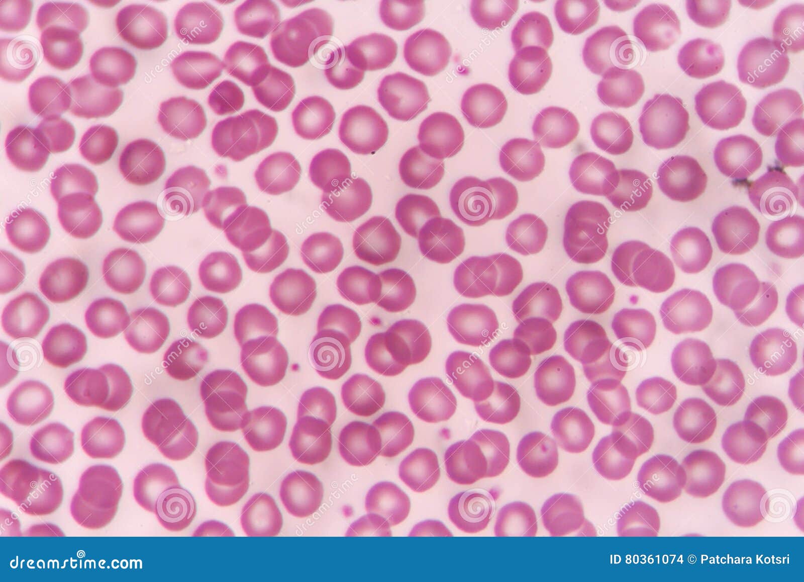 Blood smear stock photo. Image of therapy, test, medicine - 80361074