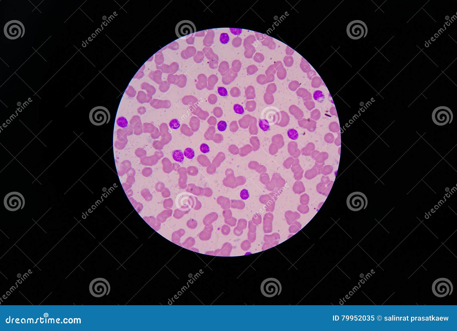 Blood Smear Showing Chronic Lymphoblastic Leukemia (CLL) Stock Image ...