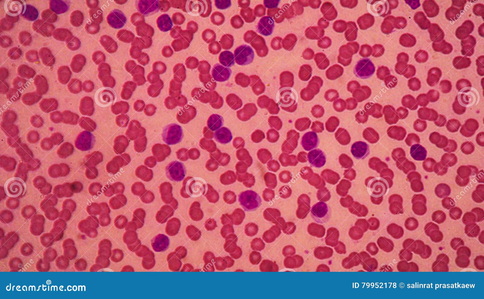 Blood Smear Showing Chronic Lymphoblastic Leukemia (CLL) Stock Photo ...