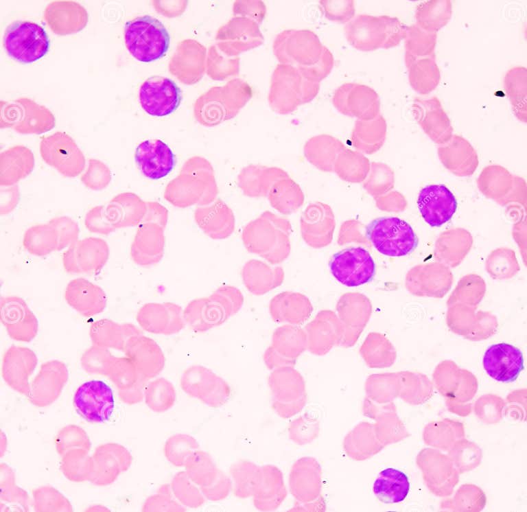 Blood Smear Showing Leukemia CLL Under Microscope Stock Image - Image ...