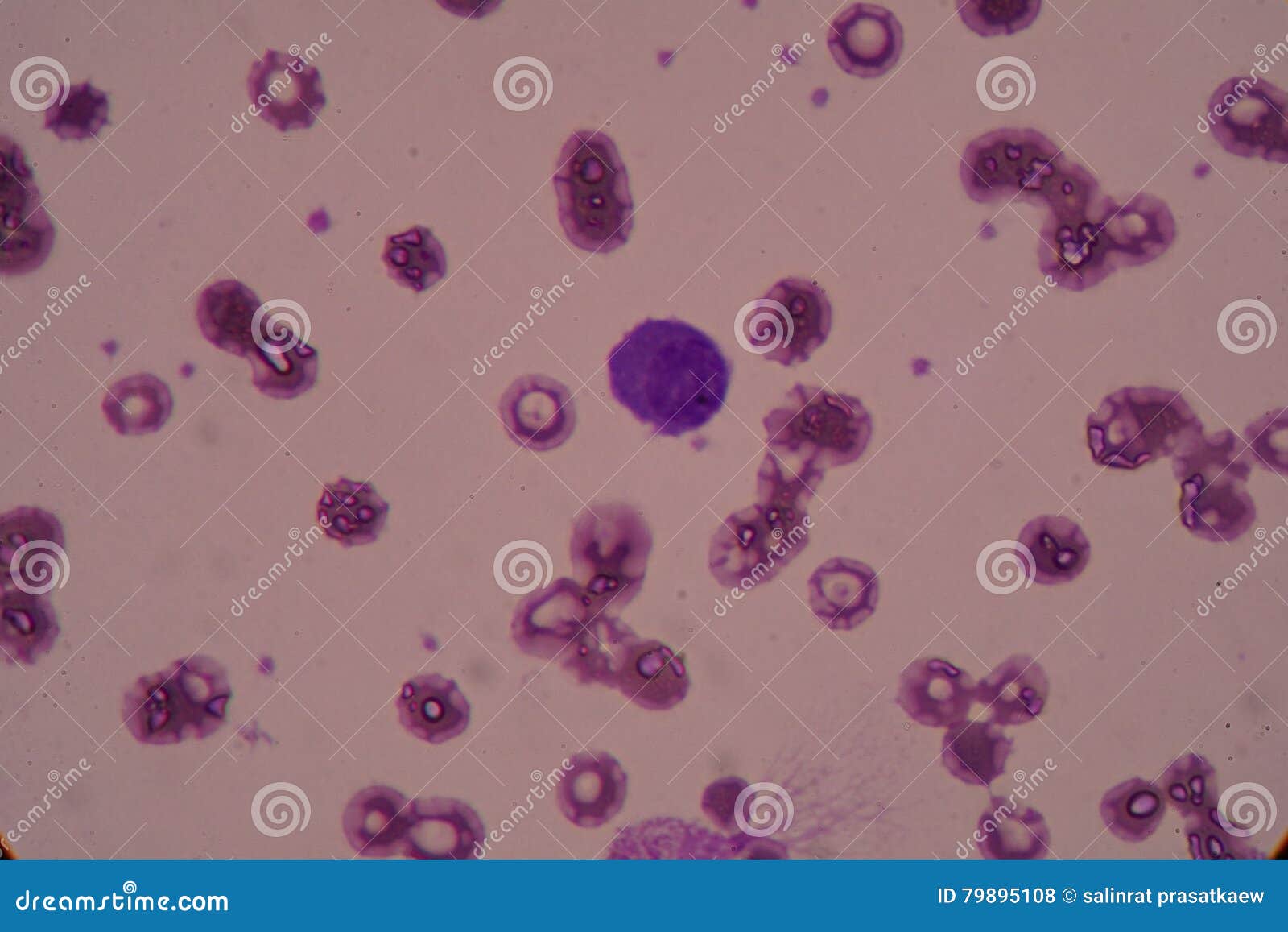 Blood Smear Showing WBC And Red Blood Cell Undermicroscope Stock ...