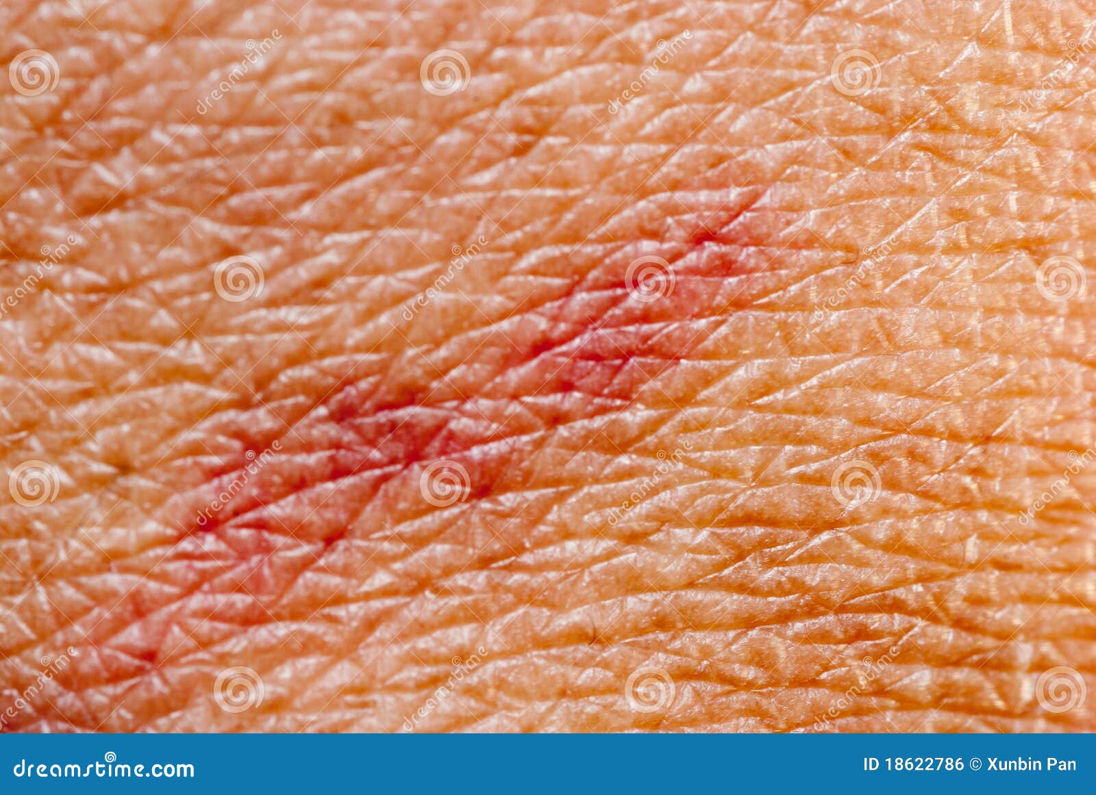 Blood stasis skin texture stock photo. Image of closeup - 18622786