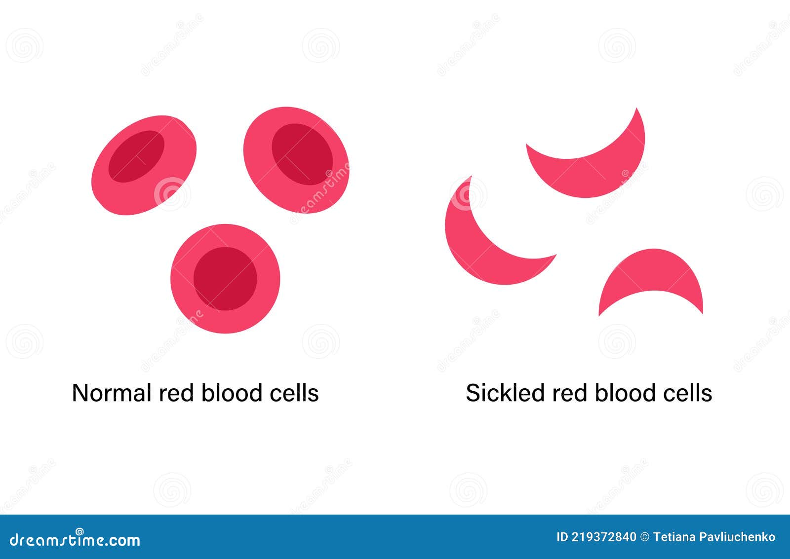 Comparison Between Normal Red Blood Cells And Sickle Cells Anemia ...