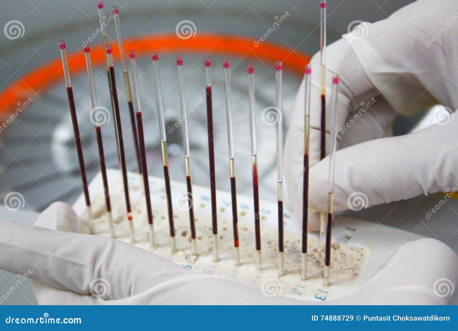Blood test stock image. Image of biological, infection - 74888729