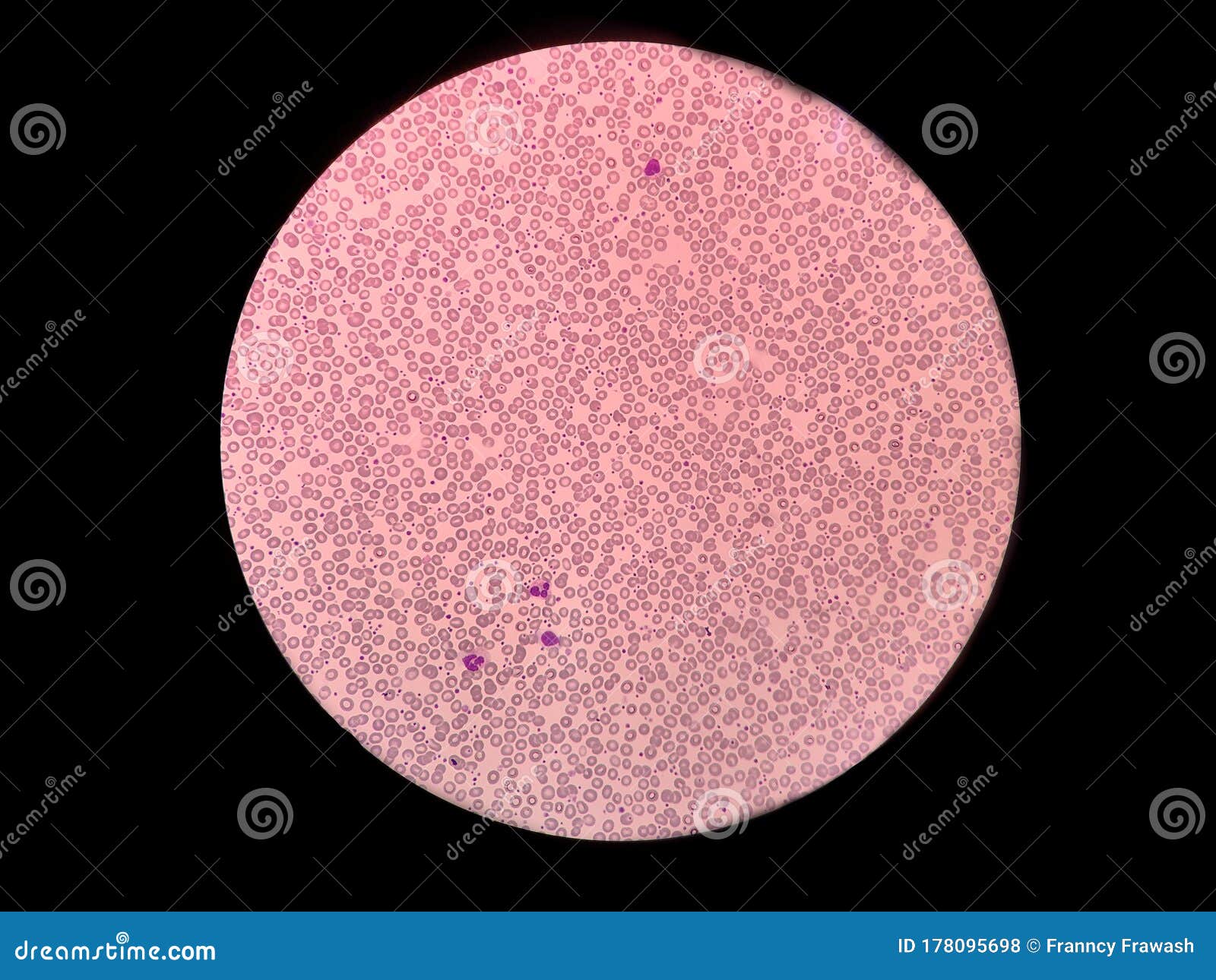 Blood Test, Red Blood Cells Stock Photo - Image of analysis, analysisn ...