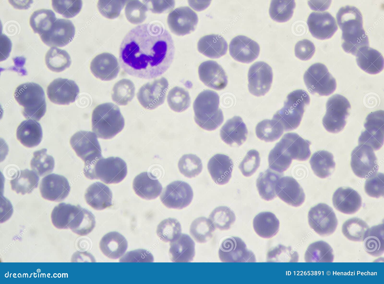Blood Under a Microscope. Lymphocyte Smear Stock Image - Image of ...
