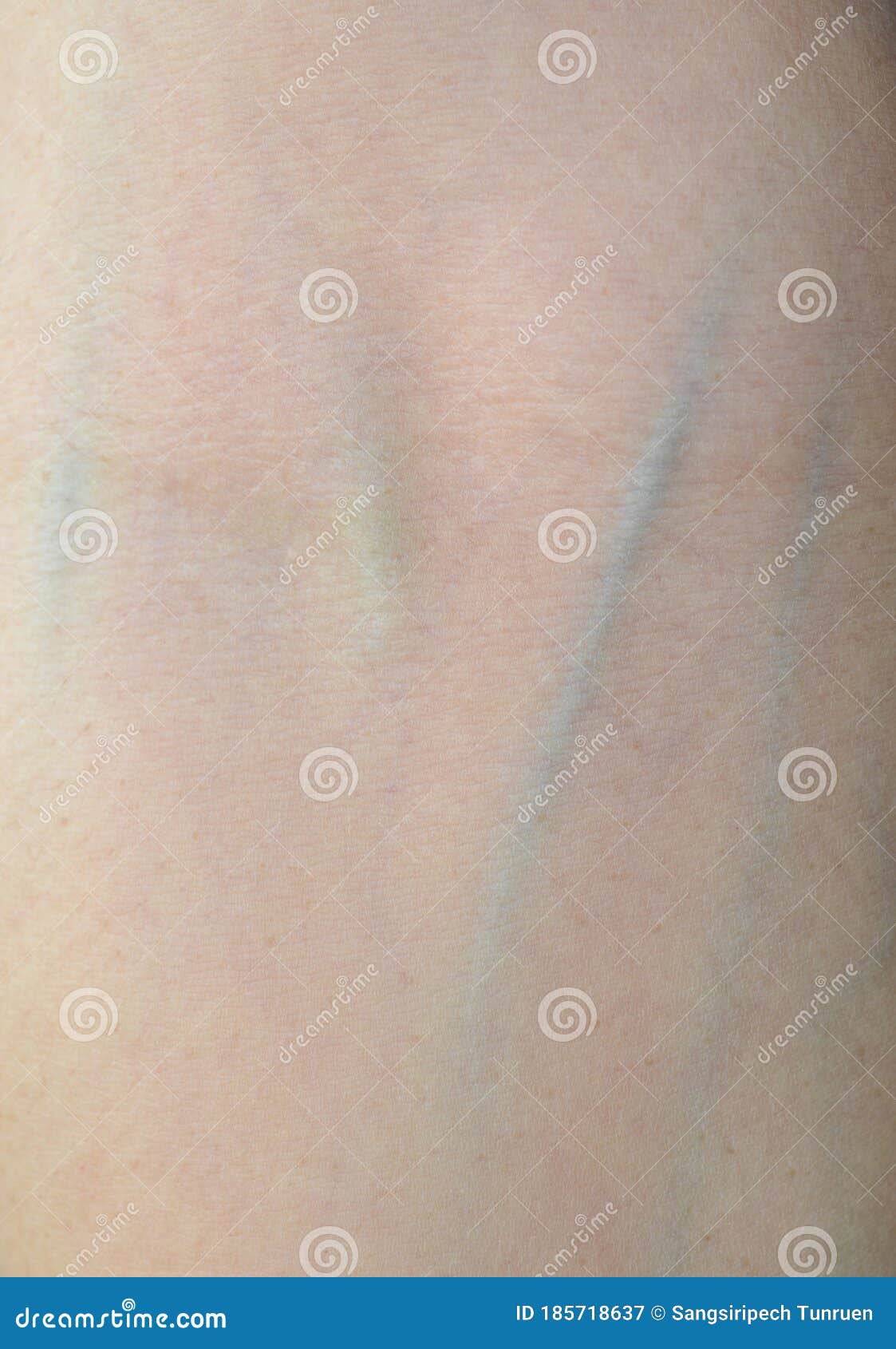 The Blood Veins of Crooked Arm Stock Image - Image of medical, blood ...