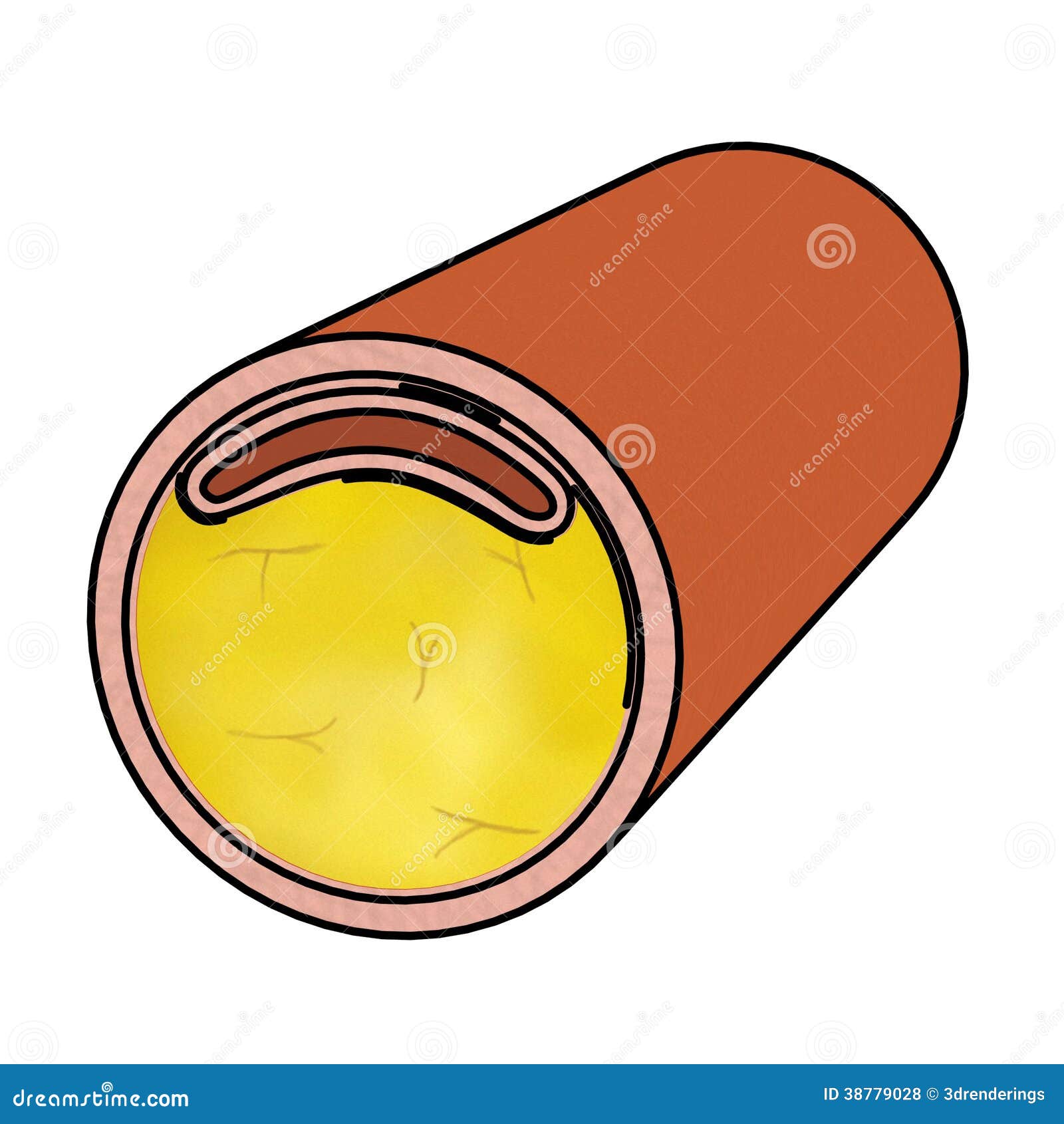 Blood Vessel with Cholesterol Stock Illustration - Illustration of ...