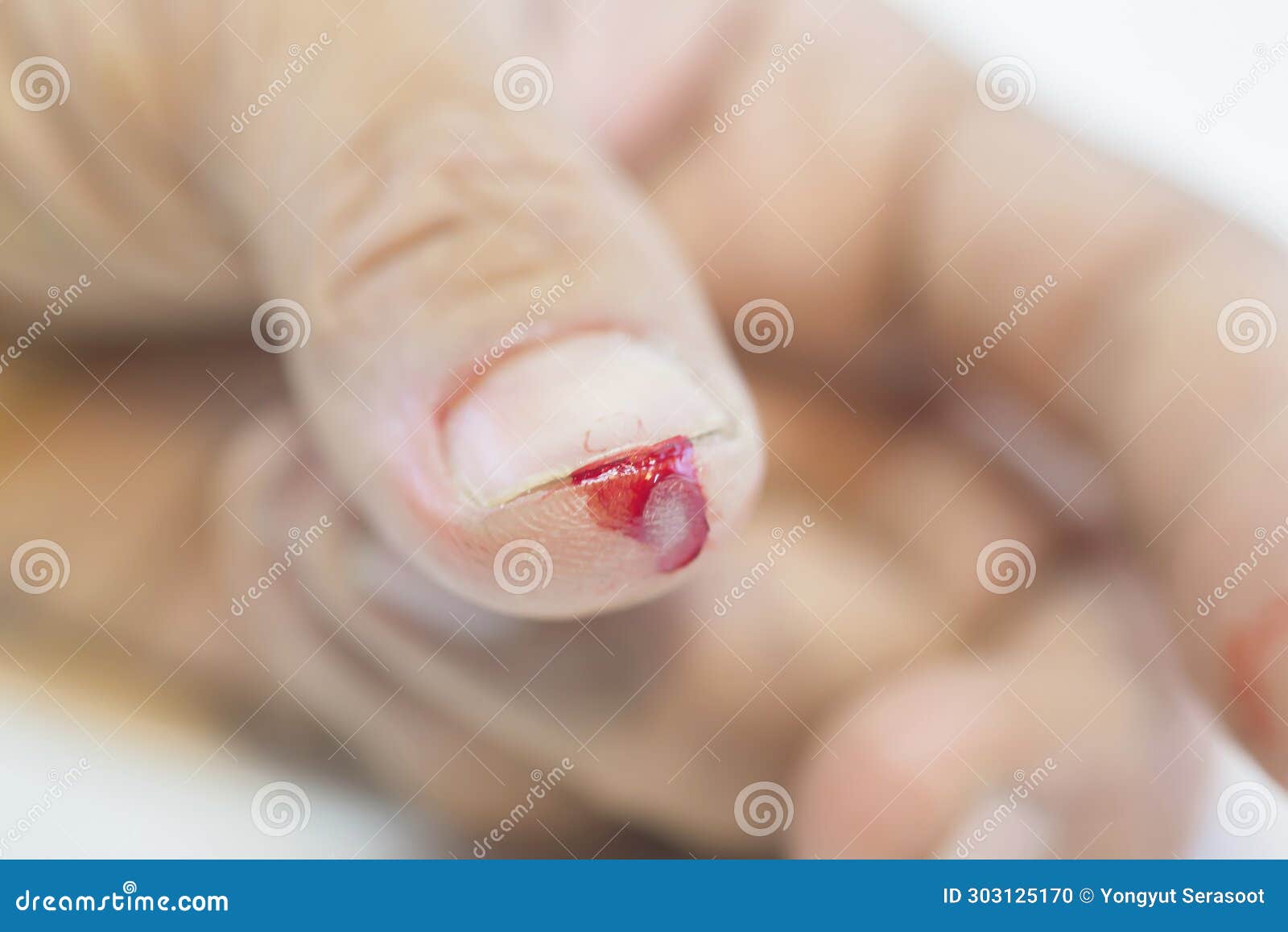 Blood and Wounds Fingernail Stock Photo - Image of danger, body: 303125170