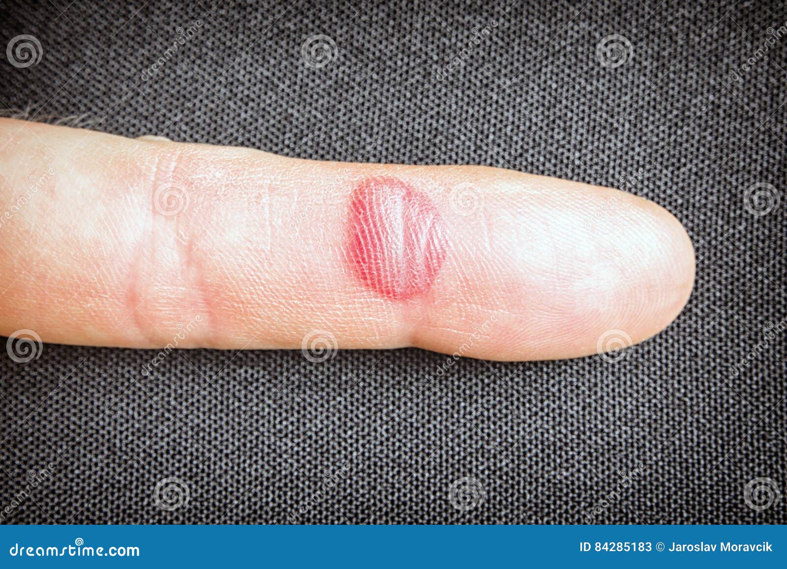 Bloody abrasion on finger stock image. Image of hand - 84285183